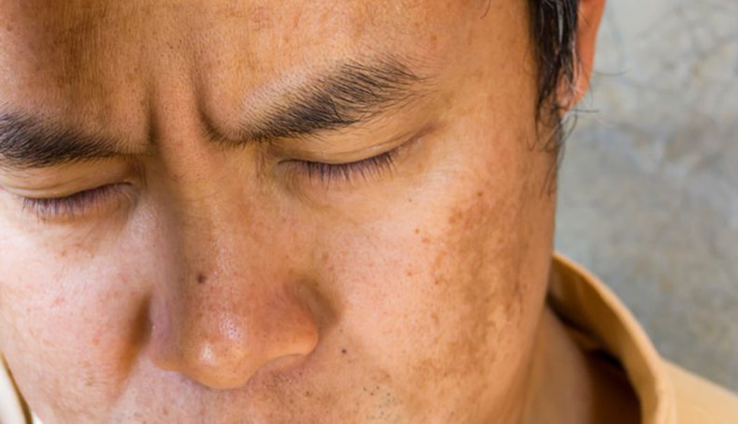 A Guide to Melasma Treatment and Common Mistakes